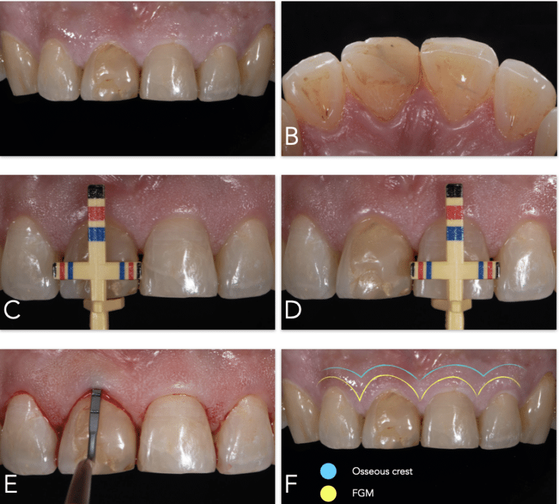 Guided Esthetic Crown Lengthening Surgery | Fredericksburg
