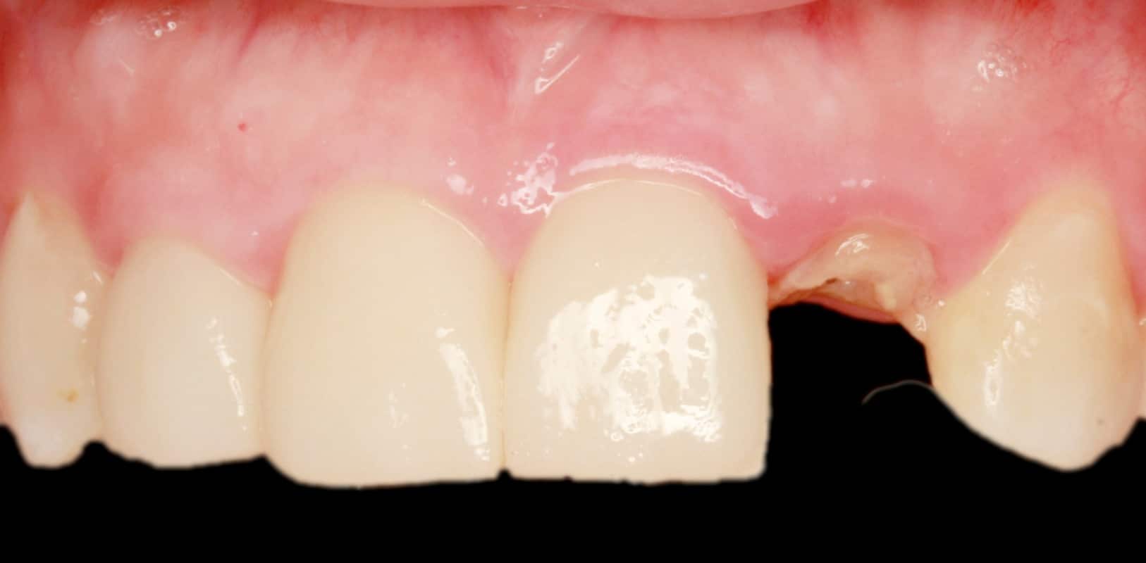 Dental Implants | Synergy Periodontics & Implants | Virginia