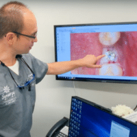 Have You Been Asking, "What Are Dental Implants?"